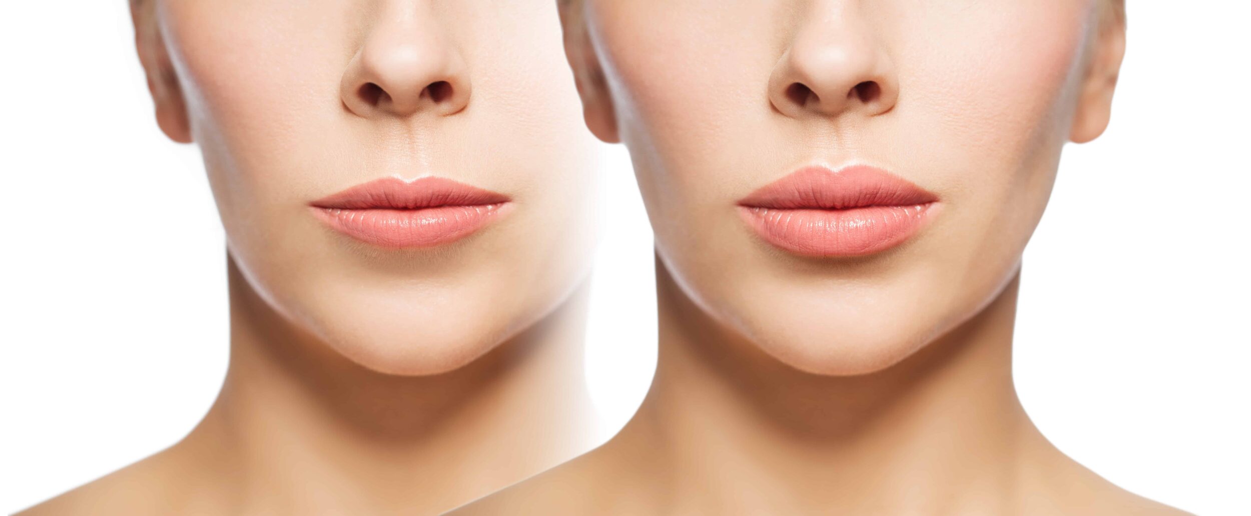 Lip Augmentation Atlanta - Lip Enhancement Dunwoody